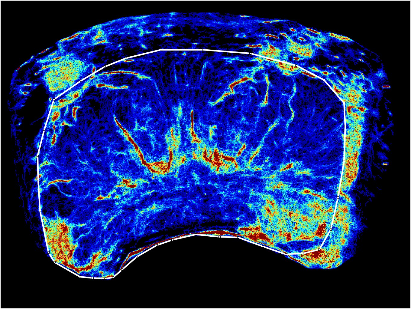 Super-Resolution Ultrasound showing detailed blood flow